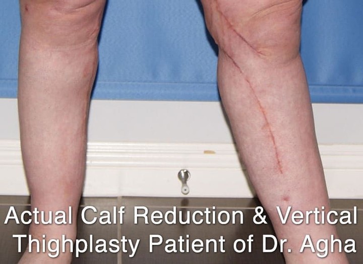 Calf Reduction & Augmentation | Newport Beach, Orange County